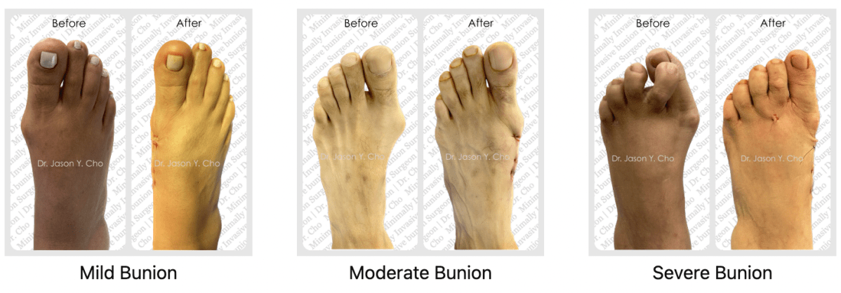 Minimally Invasive Bunion Surgery Before and After | Dr. Cho | NYC ...
