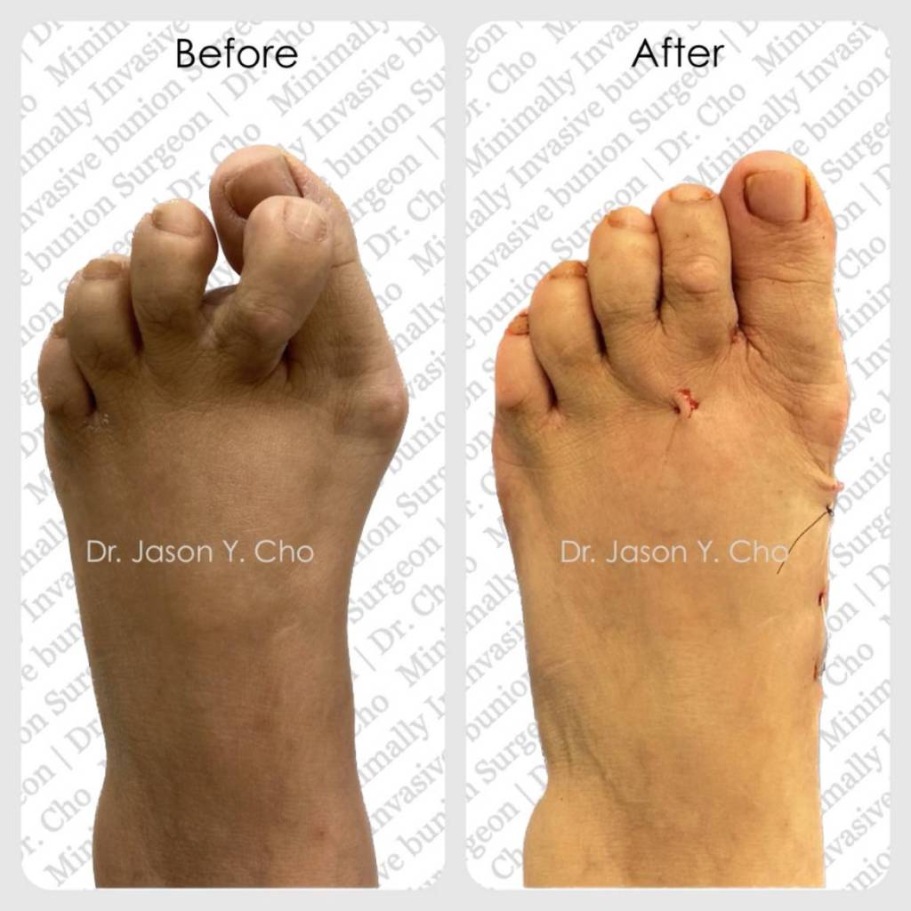 Minimally Invasive Bunion Surgery Before and After | Dr. Cho | NYC ...
