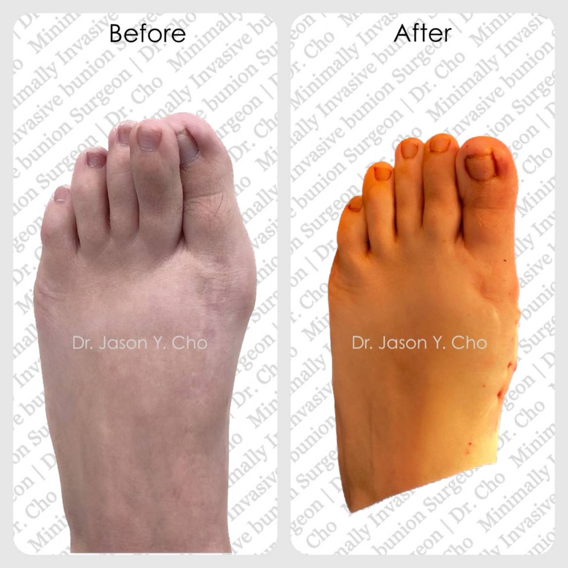 Minimally Invasive Bunion Surgery Before and After | Dr. Cho | NYC ...