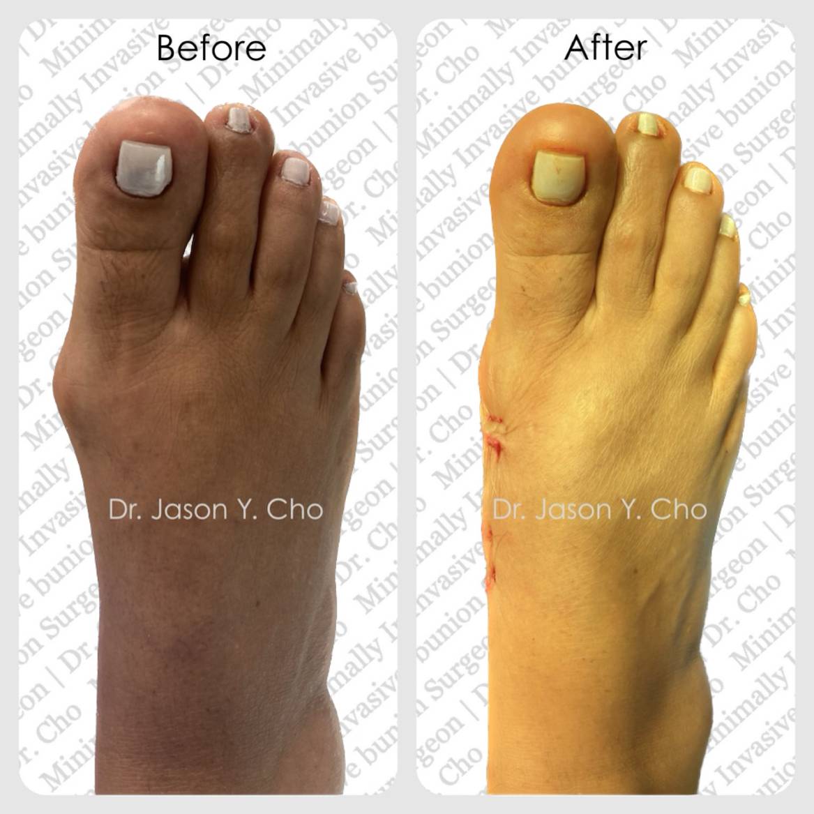 Minimally Invasive Bunion Surgery Before and After | Dr. Cho | NYC ...