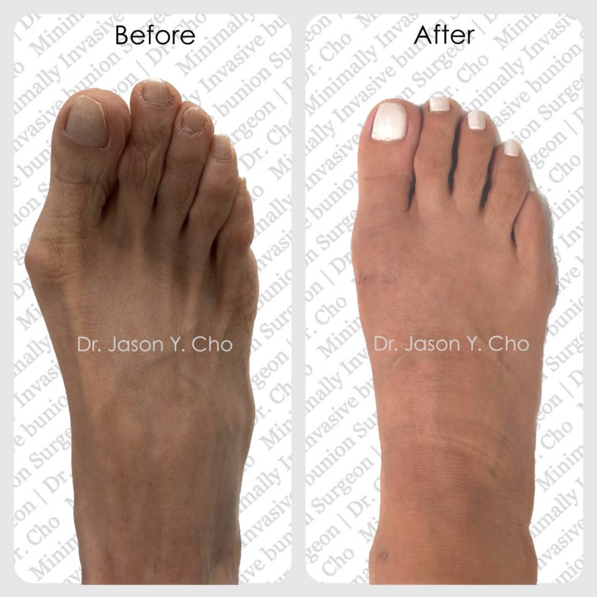 Minimally Invasive Bunion Surgery Before and After | Dr. Cho | NYC ...
