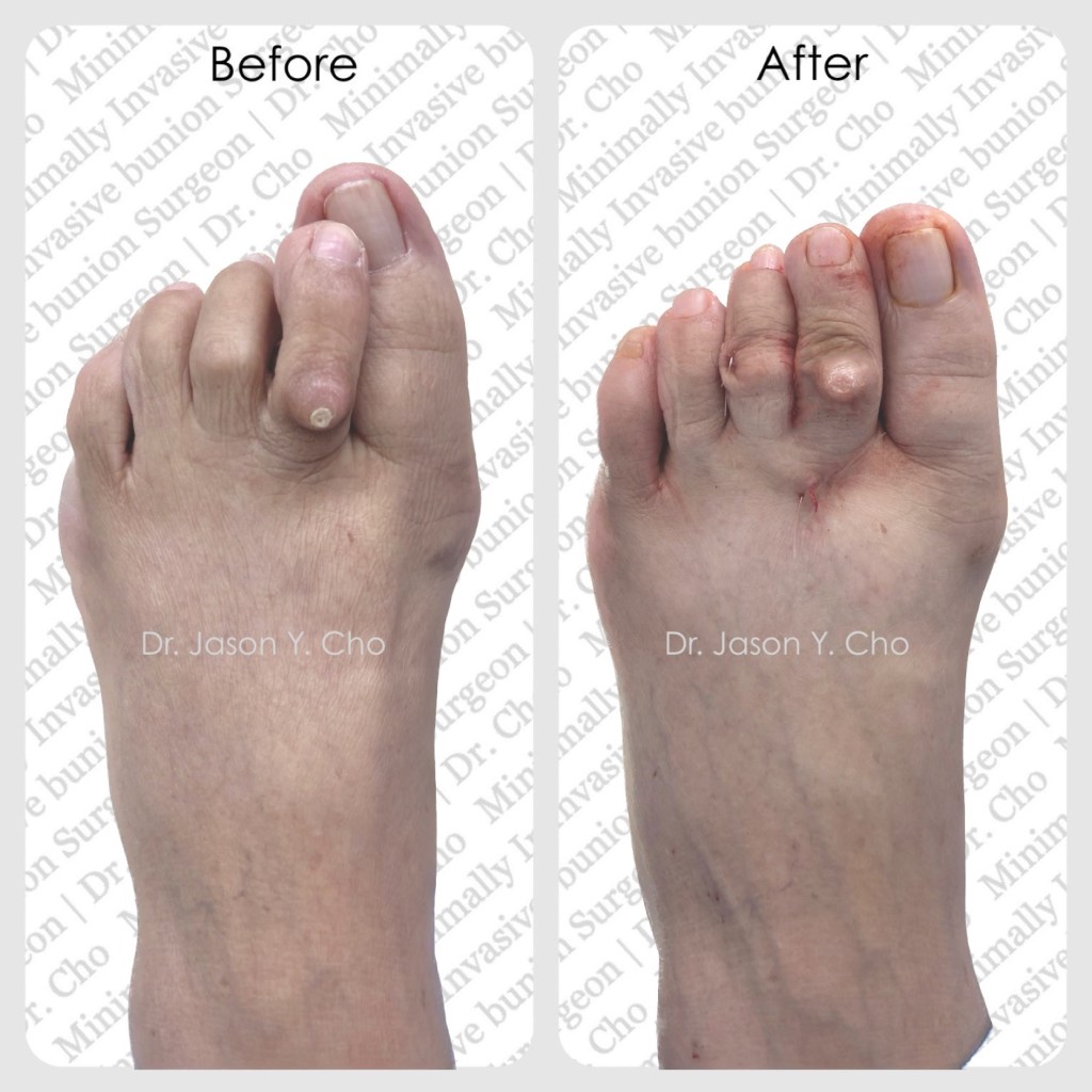 Minimally Invasive Bunion Surgery Before and After | Dr. Cho | NYC ...