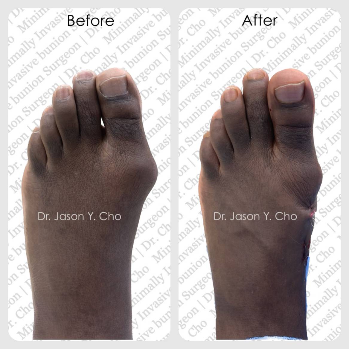 Minimally Invasive Bunion Surgery Before and After | Dr. Cho | NYC ...