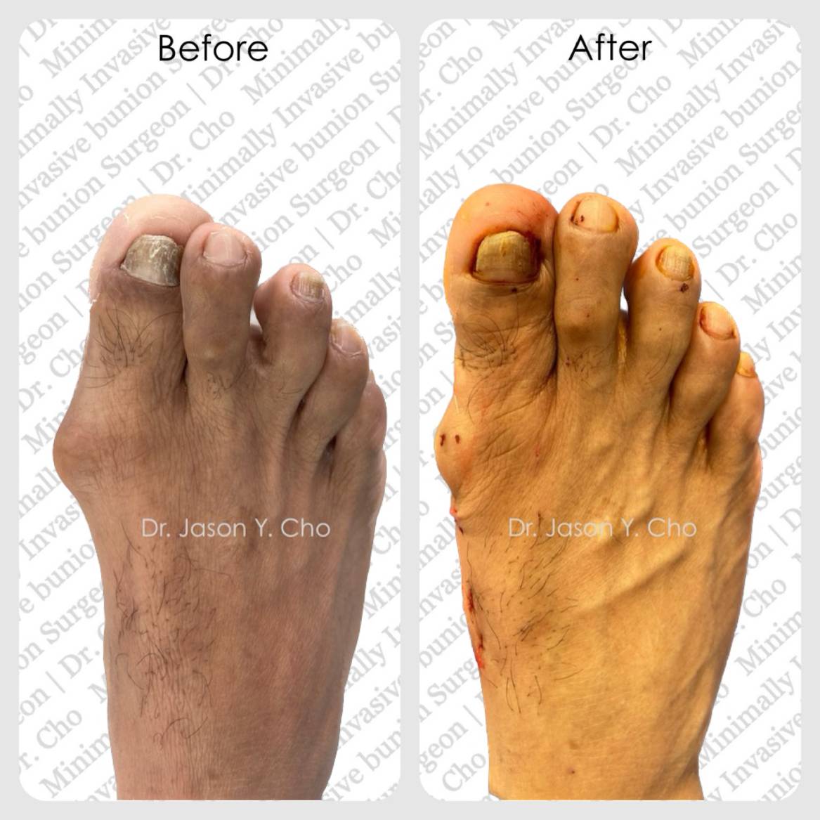 Minimally Invasive Bunion Surgery Before and After | Dr. Cho | NYC ...
