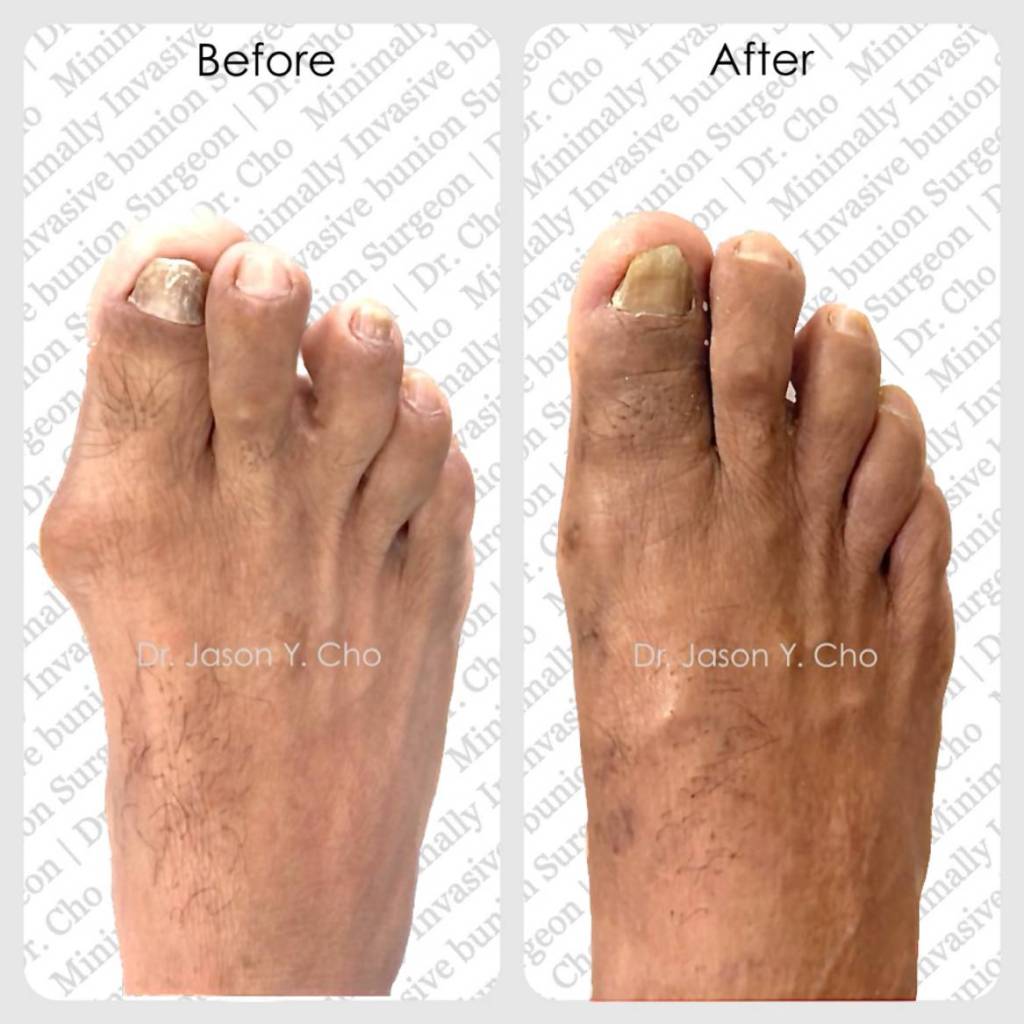 Minimally Invasive Bunion Surgery Before and After | Dr. Cho | NYC ...
