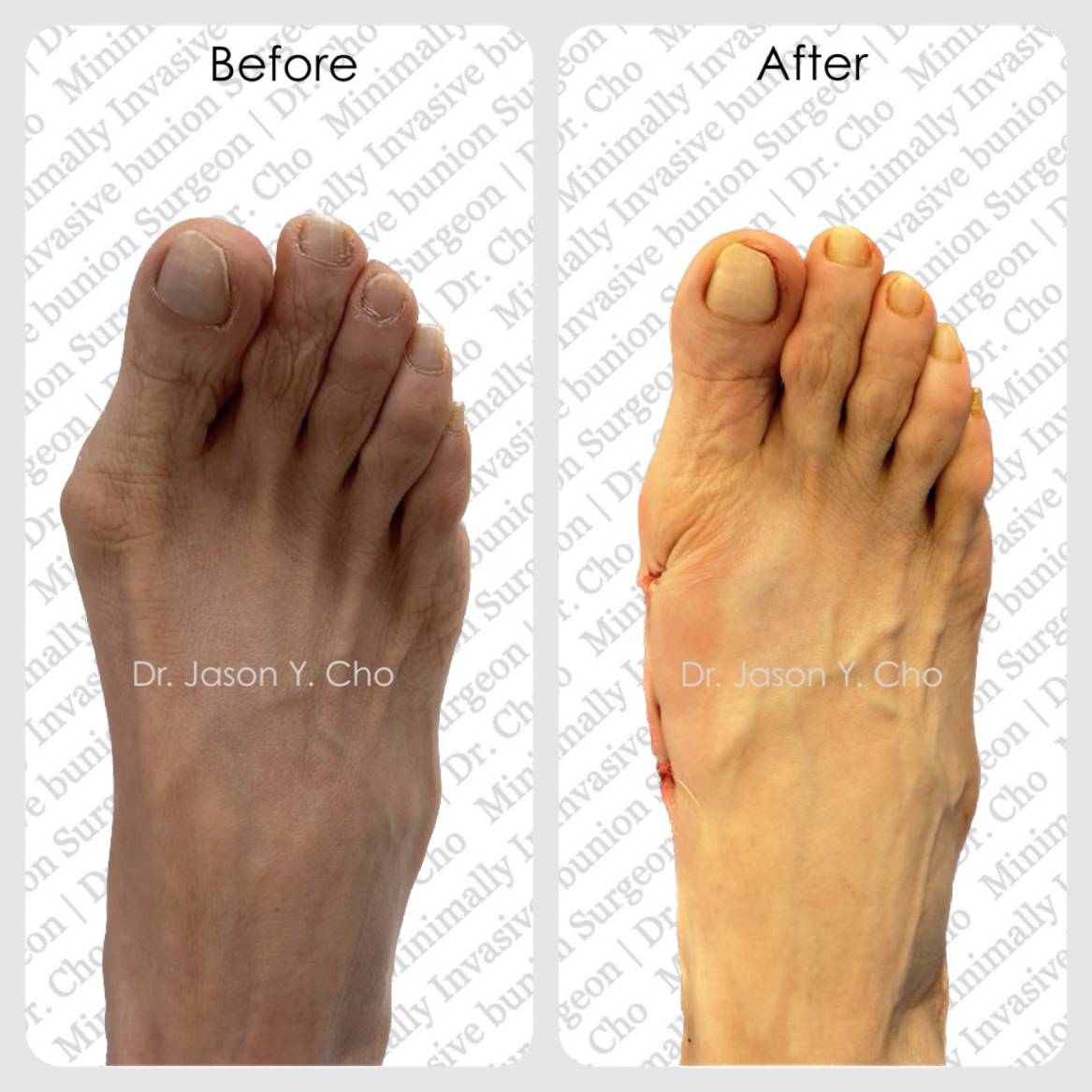 Minimally Invasive Bunion Surgery Before and After | Dr. Cho | NYC ...